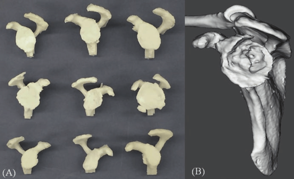 3D Printing For Shoulder Surgery « Fabbaloo