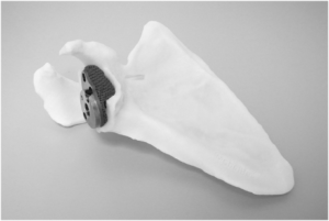 3D Printing For Shoulder Surgery « Fabbaloo