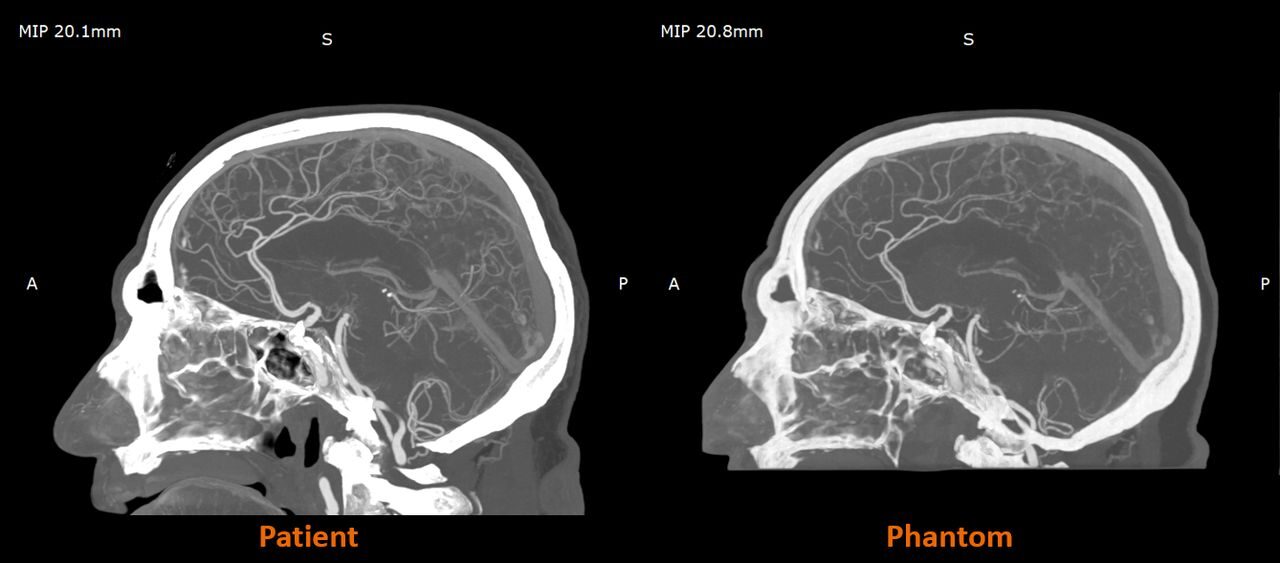 Stratasys Launches RadioMatrix Material to Enable Scannable 3D Printed Surgical Models « Fabbaloo