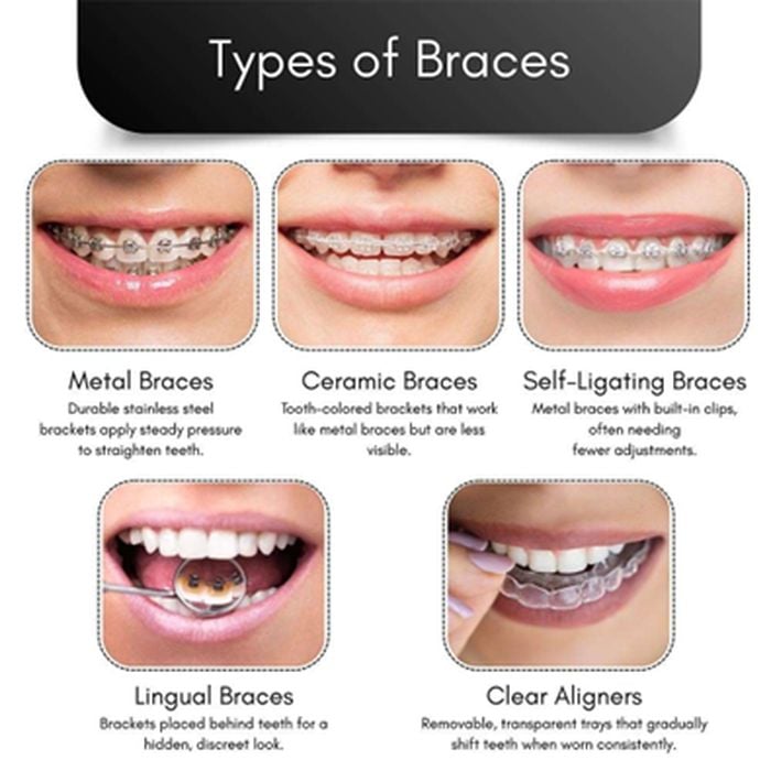 Generative Braces Move Into Metal: An Interview with LightForce’s James ...